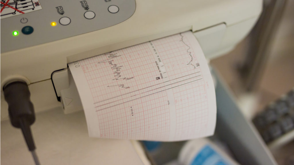 Fetal monitoring during labour - My BabyManual